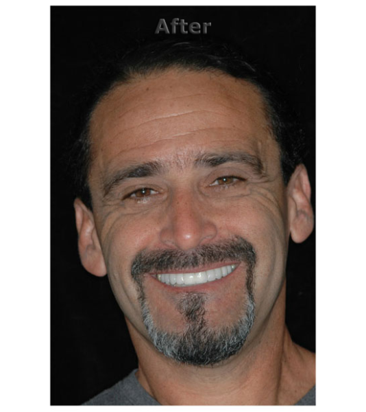 Dentist In San Clemente Ca Smile Gallery Dr Eric Johnson Before