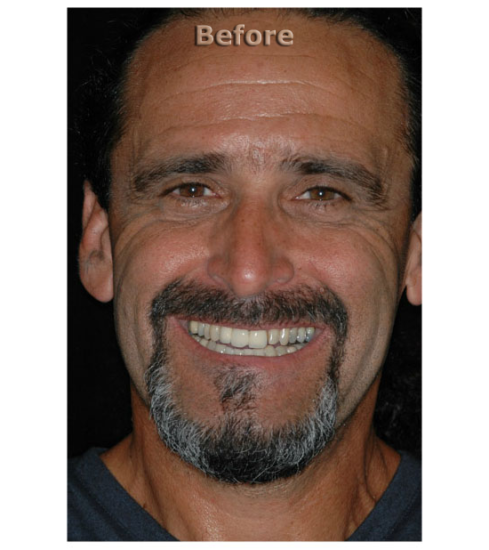 Dentist In San Clemente Ca Smile Gallery Dr Eric Johnson Before